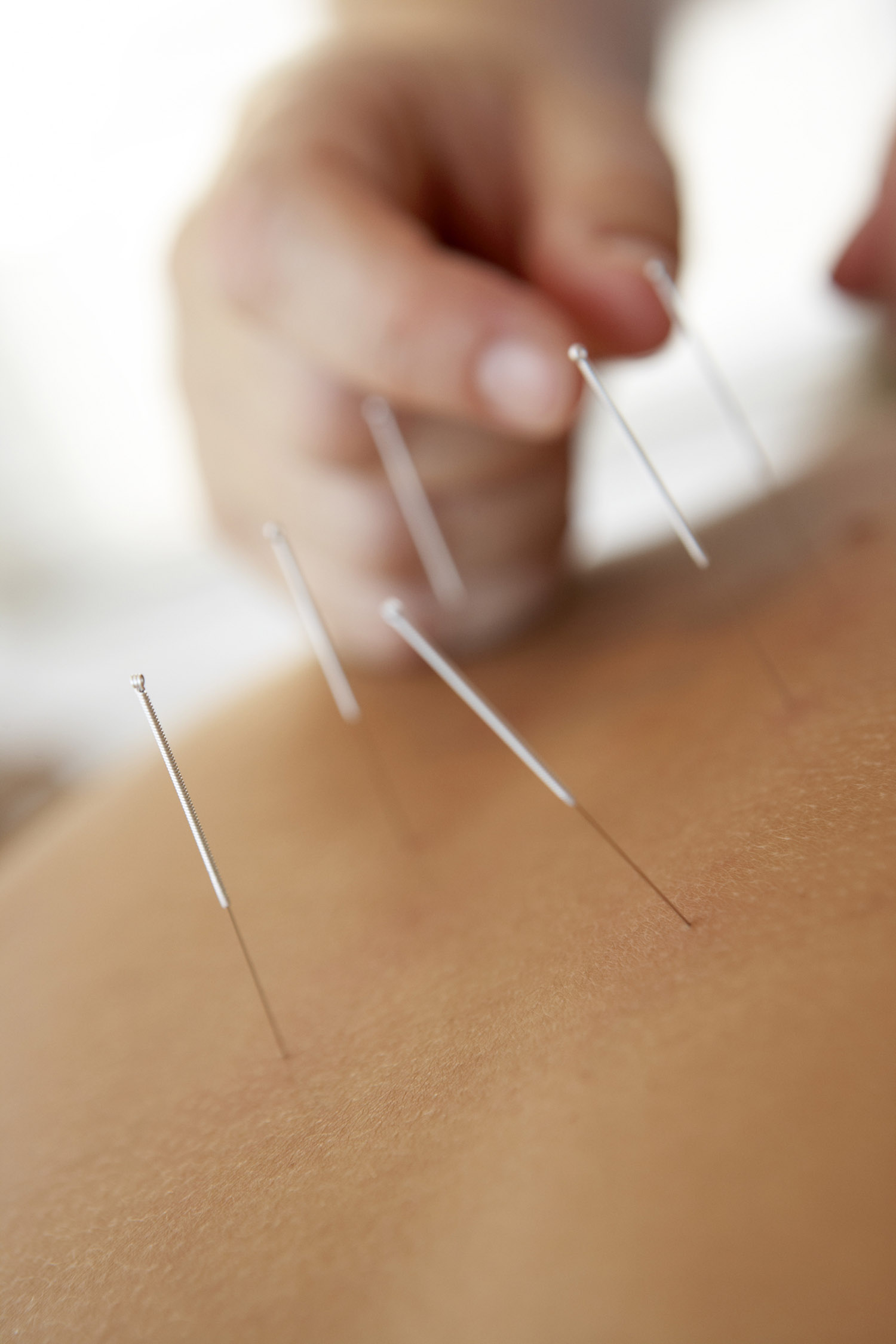 Acupuncture: How it works, uses, benefits, and risks - Bragging Mommy