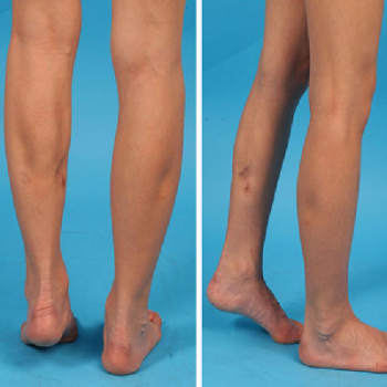 CALF REDUCTION SURGERY: EVERYTHING YOU NEED TO KNOW - Bragging Mommy