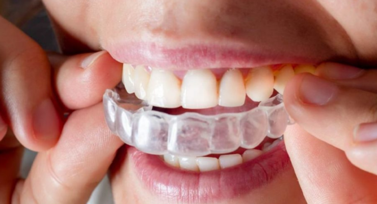 Unveiling the Science Behind Invisalign: Closing Gaps in Las Vegas ...