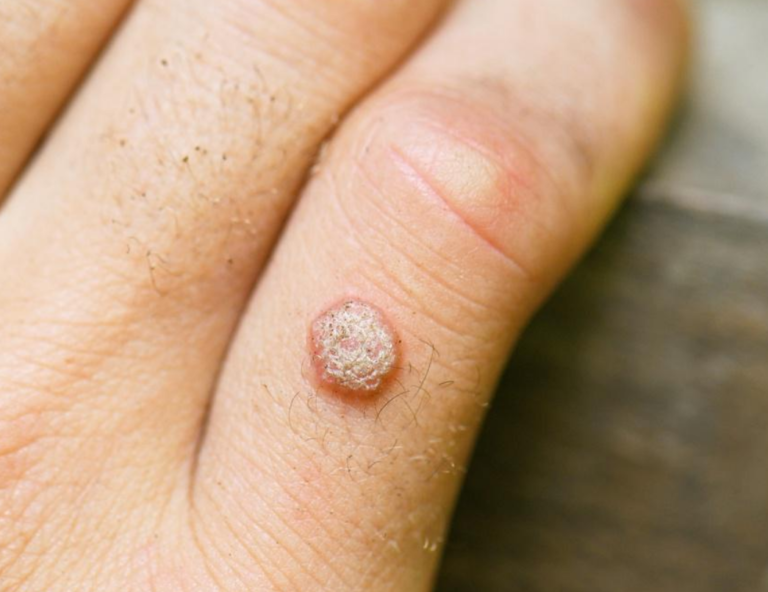 The Common Facts about Warts that You Should Know - Bragging Mommy