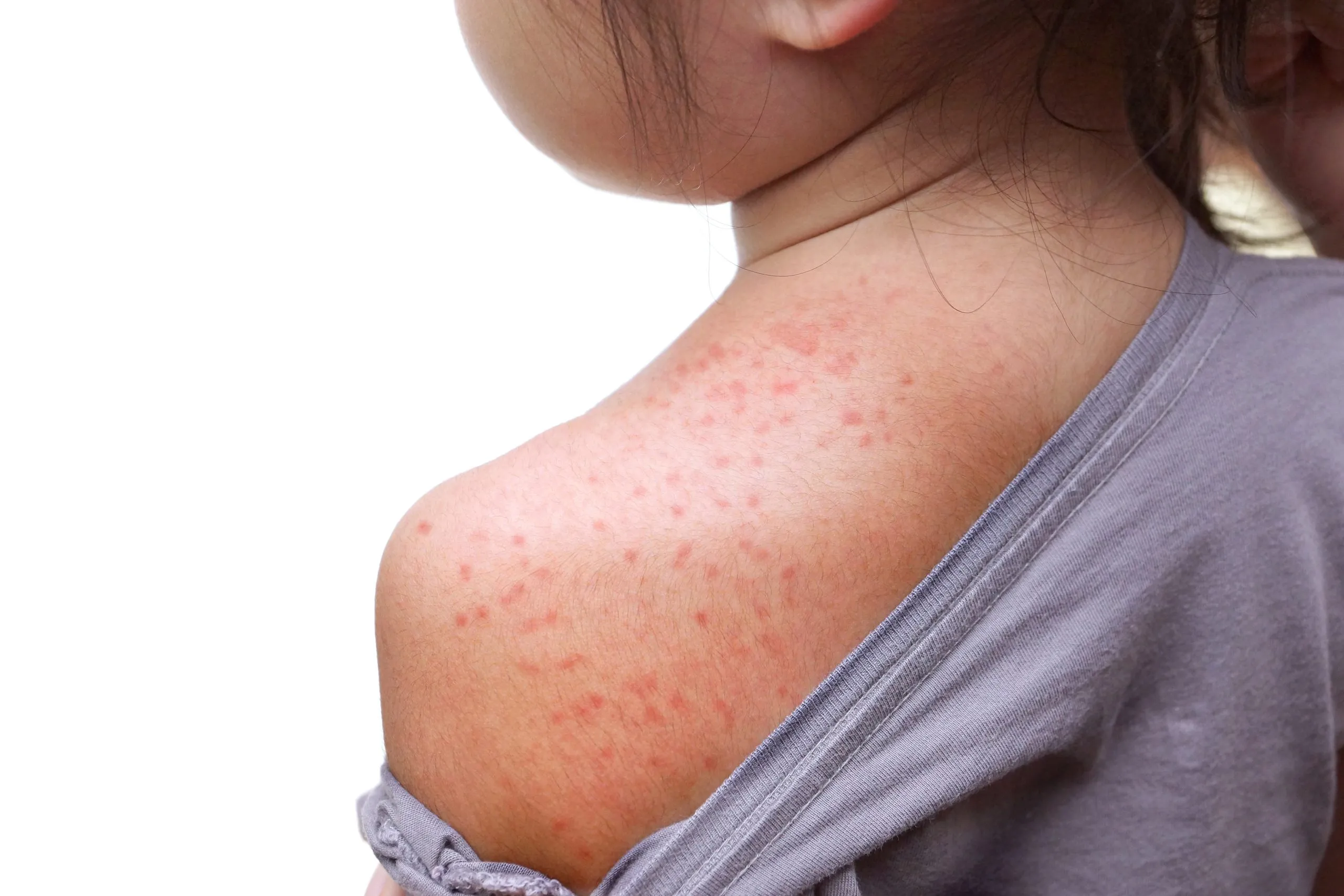 Skin rashes that worry parents — and when to take action - Bragging Mommy